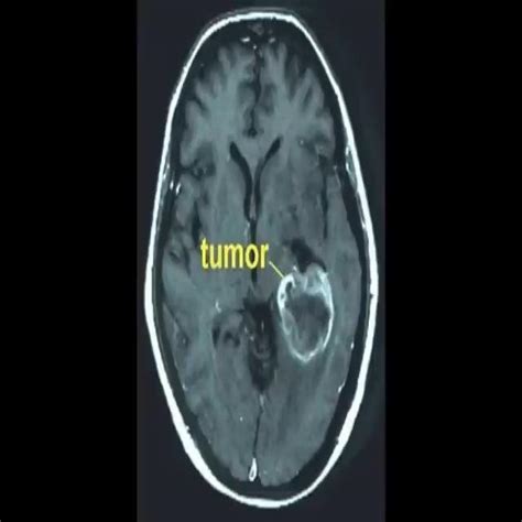 brain tumor detection object detection dataset v2 mahitha by brain tumor