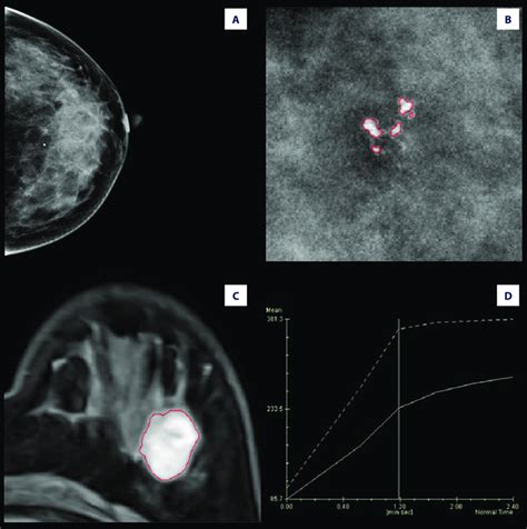 An Example Of Roi Segmentation In The Left Breast Of A Patient A