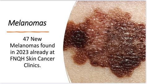 Vin Rajeswaran On Linkedin Gpwsi Skincancer Melanoma Fnqh