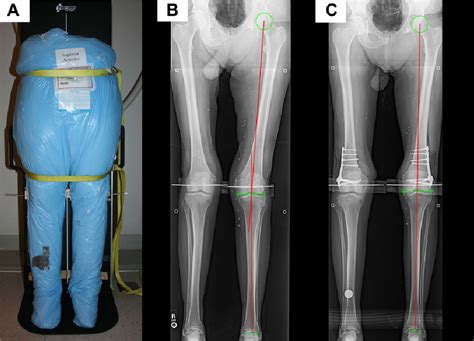 Figure 1 From Derotational Osteotomy Of The Distal Femur For The