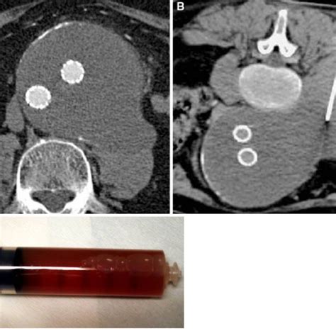 Type 2 Endoleak At Contrast Enhanced Ct Download Scientific Diagram