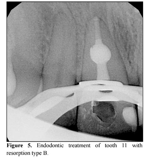 Pdf Tooth Root Resorption Etiopathogenesis And Classification