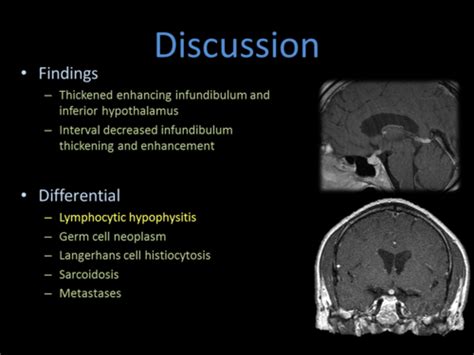 Pituitary Disease Dr Freeman Flashcards Quizlet