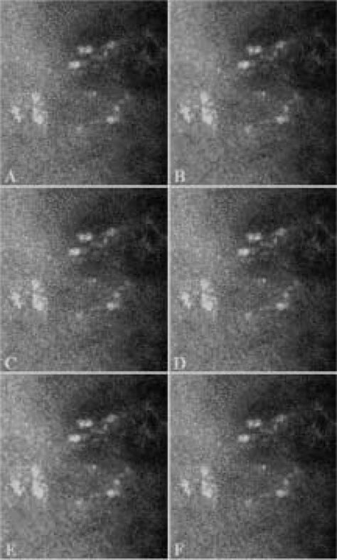 Region Of Interest Containing A Cluster Of Microcalcifications A