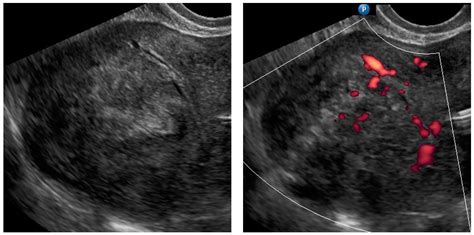 Bicornuate Uterus Ultrasound