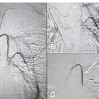 A Digital Subtraction Angiography DSA Image After Super Selective Download Scientific Diagram