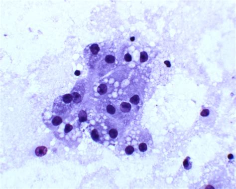 Transitional Cell Carcinoma Cytology
