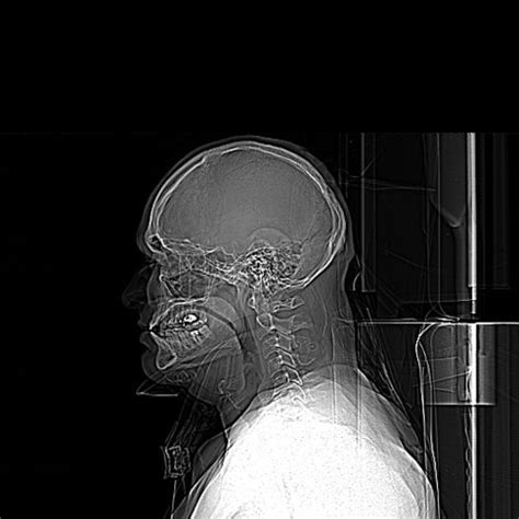 Dwayne Lee Ct Scan Skull Head And Neck Cts