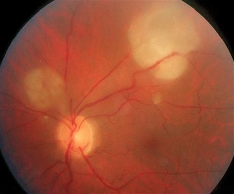 Cryptococcus Endogenous Endophthalmitis Retina Image Bank Cryptococcus Endogenous Endophthalmitis Retina Image Bank