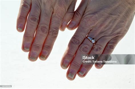 곰팡이 손톱 감염 셸락 또는 젤 바니시 후 의식 용해 흰색 배경에 격리 건강관리와 의술에 대한 스톡 사진 및 기타 이미지 건강관리와 의술 건선 근거리 초점 Istock