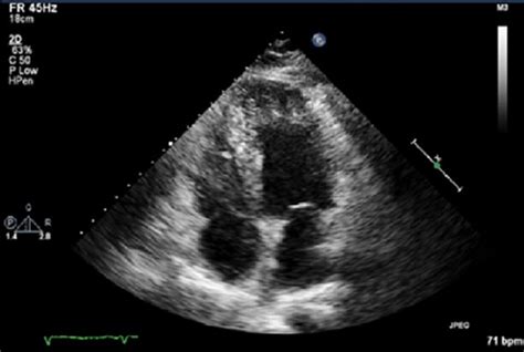 Apical Four Chamber View In TTE Contrast Revealed Prominent Apical Download Scientific Diagram