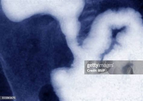 Appendicitis Photos And Premium High Res Pictures Getty Images