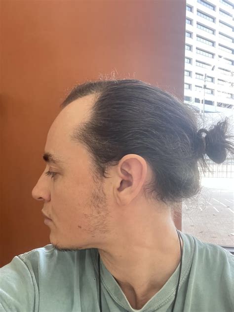 Update 35ftm W Vegeta Hairline Pondering The Buzz And The Buzz Won