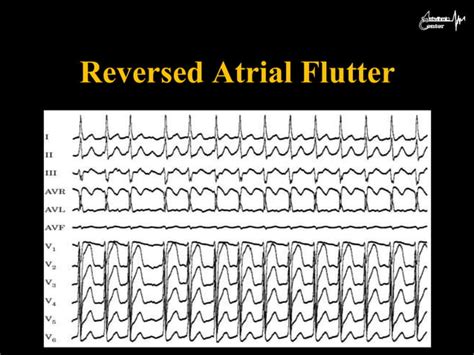 Ablation Of Atypical Flutter Pptx