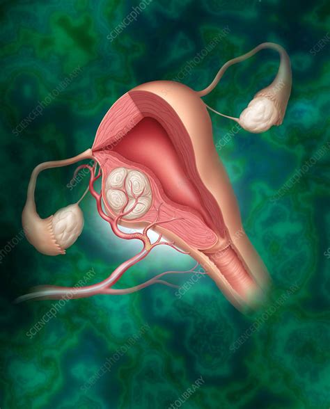 Uterine Artery Embolization Stock Image C001 5013 Science Photo Library