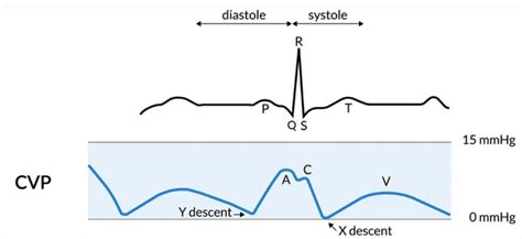 Abnormal Cvp Waveform