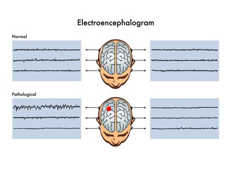 Electroencephalogram Eeg