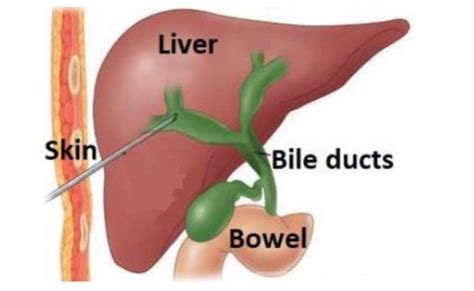 Percutaneous Transhepatic Biliary Drainage Ptbd Dr Ankit