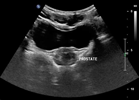 Prostate Gland Scan Ultrasound Scan