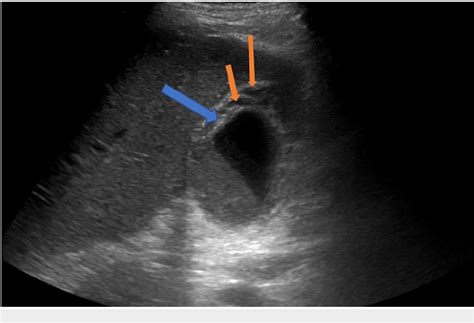 Figure 2 From Occult Perforated Gangrenous Gallbladder Found On Magnetic Resonance