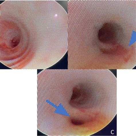 A Endoscopic View Of Left And Right Hepatic Ducts B Endoscopic Download Scientific Diagram