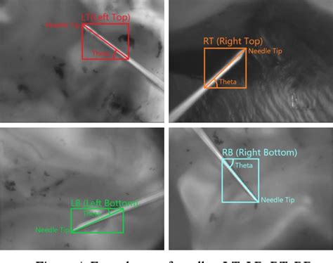 The Neural Networks Based Needle Detection For Medical Retinal Surgery Paper And Code