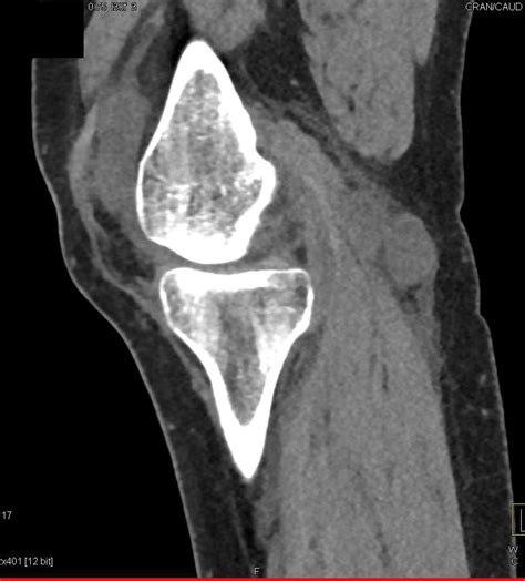 Baker Cyst Knee X Ray At Alexis Kevin Blog
