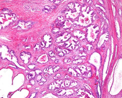 Benign Prostatic Hyperplasia Light Micrograph Stock Image C060 8369 Science Photo Library