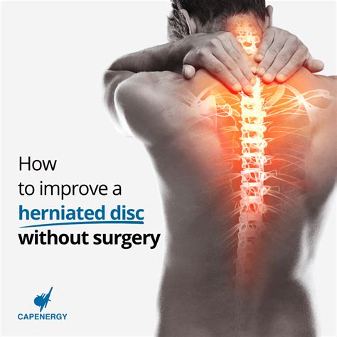 How To Improve A Herniated Disk Without Surgery Capenergy Medical