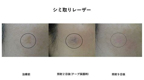 シミ取りレーザー後にテープはどうして必要？？ 【美容皮膚科が教える★美肌の作り方】美容皮膚科wove（ウォブ）クリニックブログ