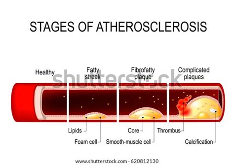 Stages Atherosclerosis Detailed Illustration Healthy Artery Stock
