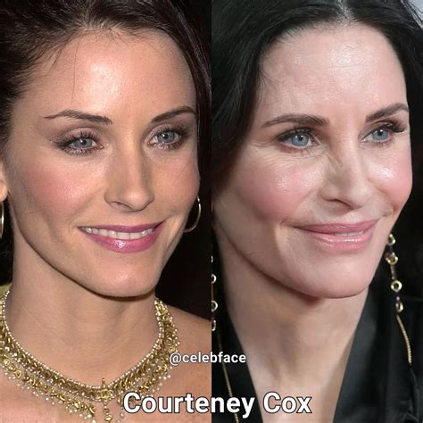 Botox Before And After Celebrity