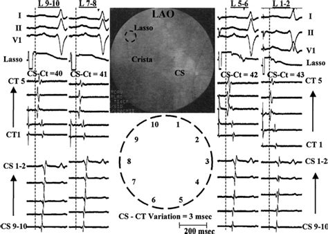 A Typical Example Of The Activation Pattern When Pace Mapping Pm Is Download Scientific