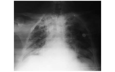Chest Radiography Showing Bilateral Infiltrates Download Scientific Diagram