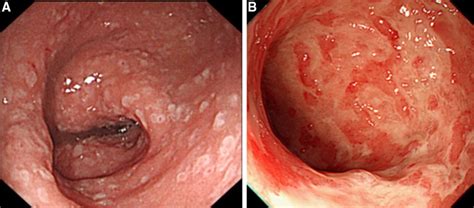 Endoscopic Features Of Patients With Ibd And Cdi A Pseudo Membrane Was