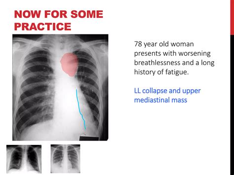 Cxr Interpretation Pptx