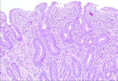 Biopsy From The Patients Second Portion Of Duodenum Showing Almost Download Scientific Diagram