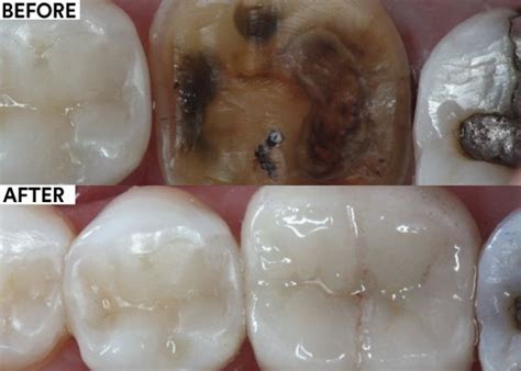 Clinical Case Selective Etch Adhesive Bonding Of A Glass Ceramic Onlay