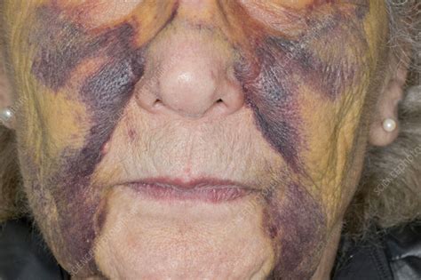 Bruised Face Everything You Need To Know About Bruising After