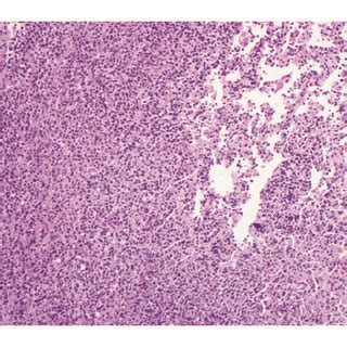 A Low Power View Shows The Tumor Cells In A Diffuse Growth Pattern In Download Scientific