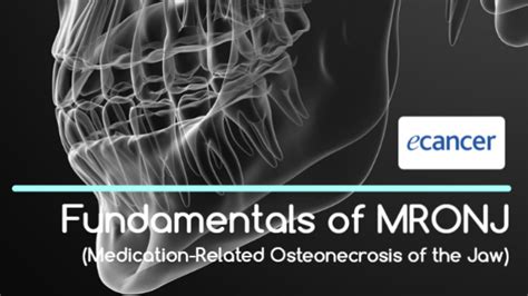 Fundamentals Of Mronj Medication Related Osteonecrosis Of The Jaw