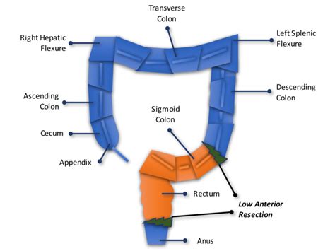 Low Anterior Resection Surgery — Love Your Buns