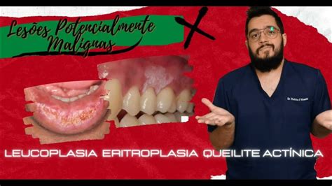 Lesões Potencialmente Malignas Leucoplasiaeritroplasiaqueilite