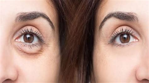 6 طرق منزلية فعالة للتخلص من انتفاخات تحت العين