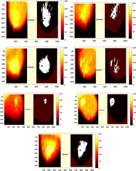 Cancer Detection By Dlho Algorithm Download Scientific Diagram