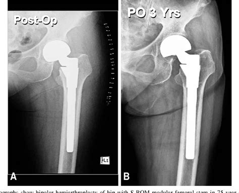 Figure 1 From Hip Arthroplasty Using Cementless Modular Femoral Stem