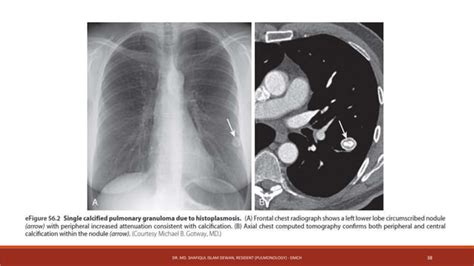 Fungal Pneumoniapptx