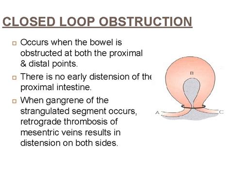 Intestinal Obstruction Types Of Intestinal Obstruction Dynamic Where