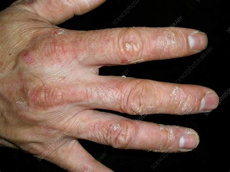 Contact Dermatitis Stock Image C056 5400 Science Photo Library