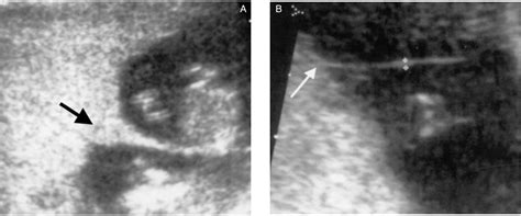 T Sign In Monochorionic Twins Twin Pregnancies With Lambda Sign On Ultrasound Examination